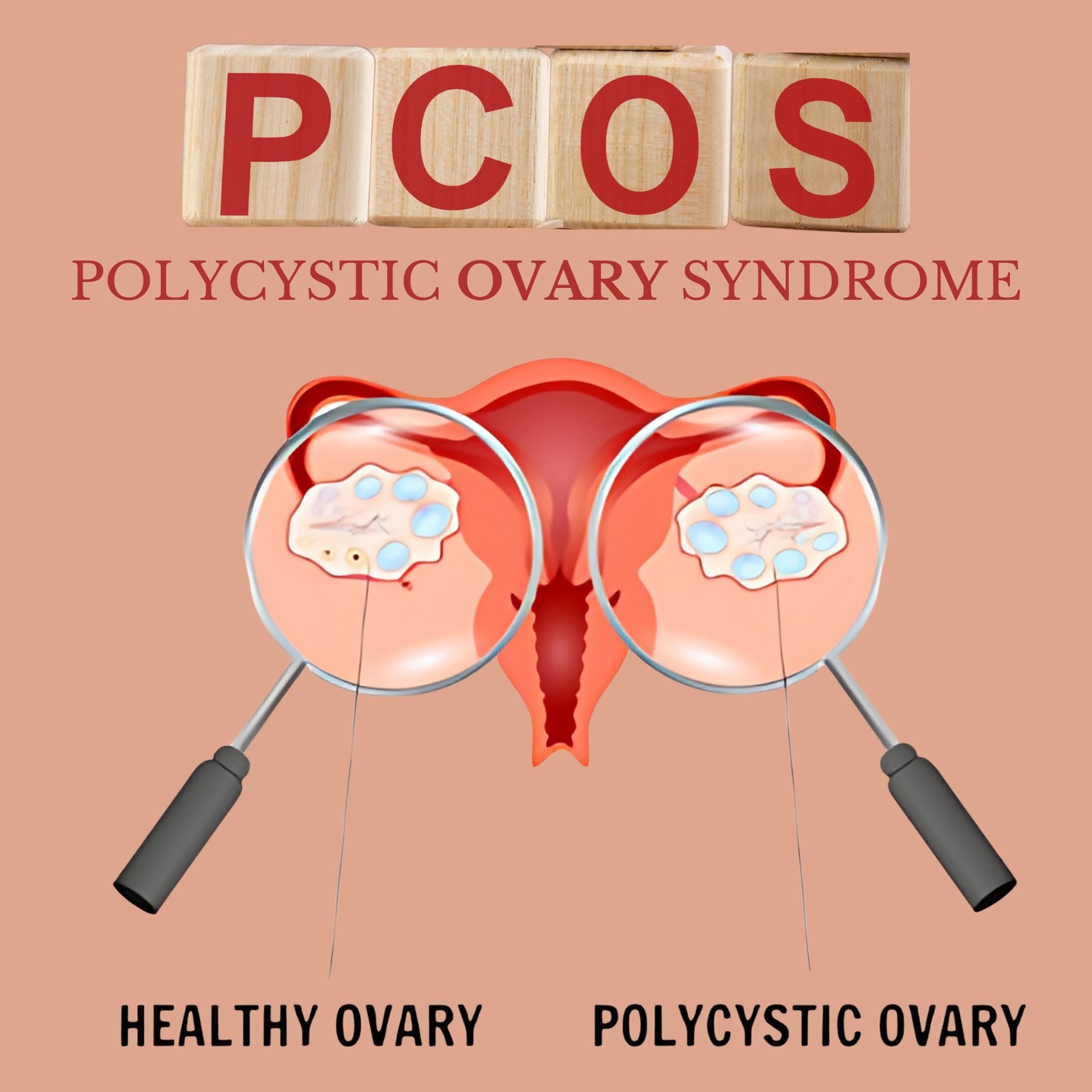 PCOS Management Program | Balanced Health Care